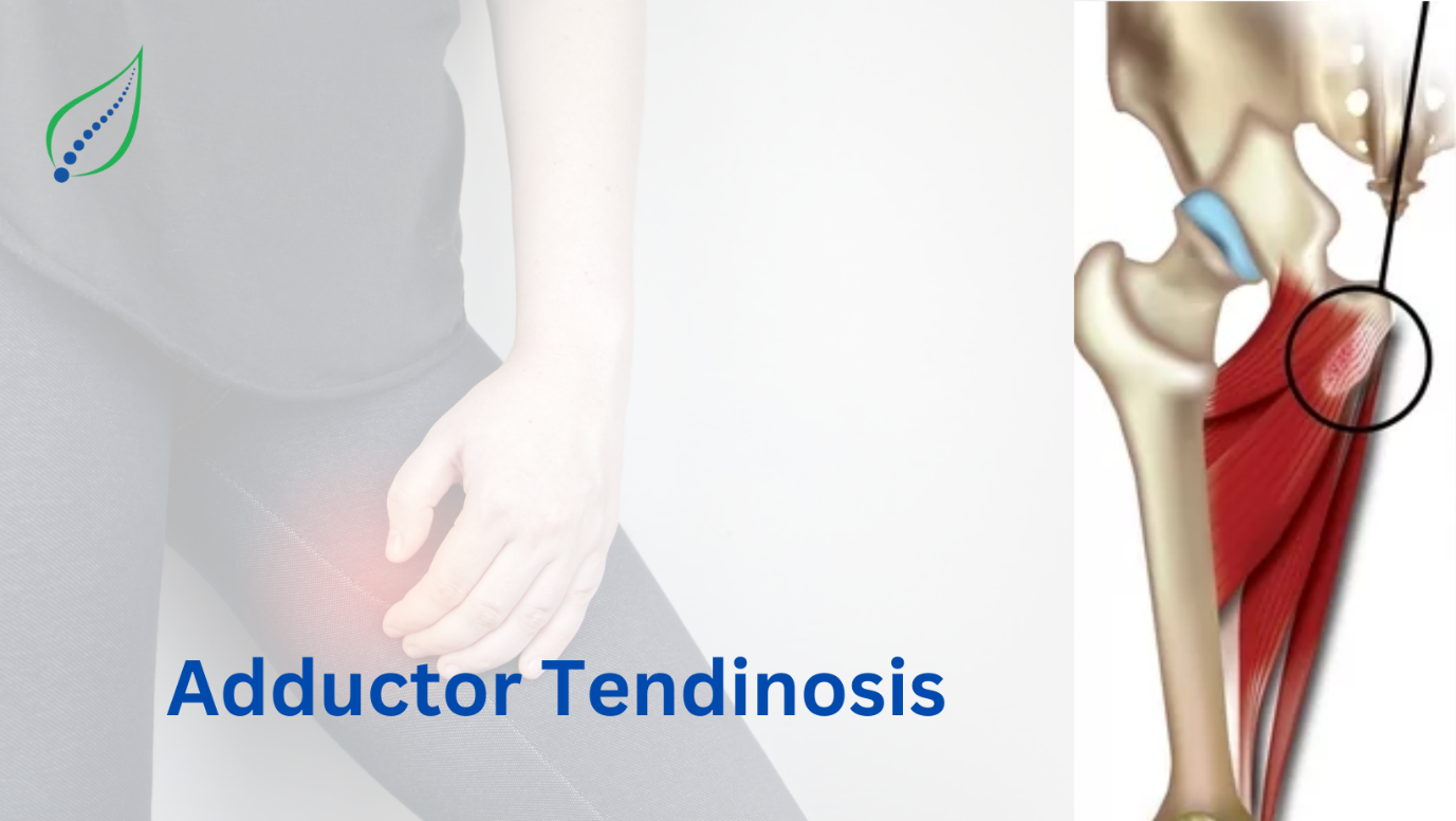 Best Adductor Tendinosis Treatment | Spinalogy Pune | Best Back Pain ...