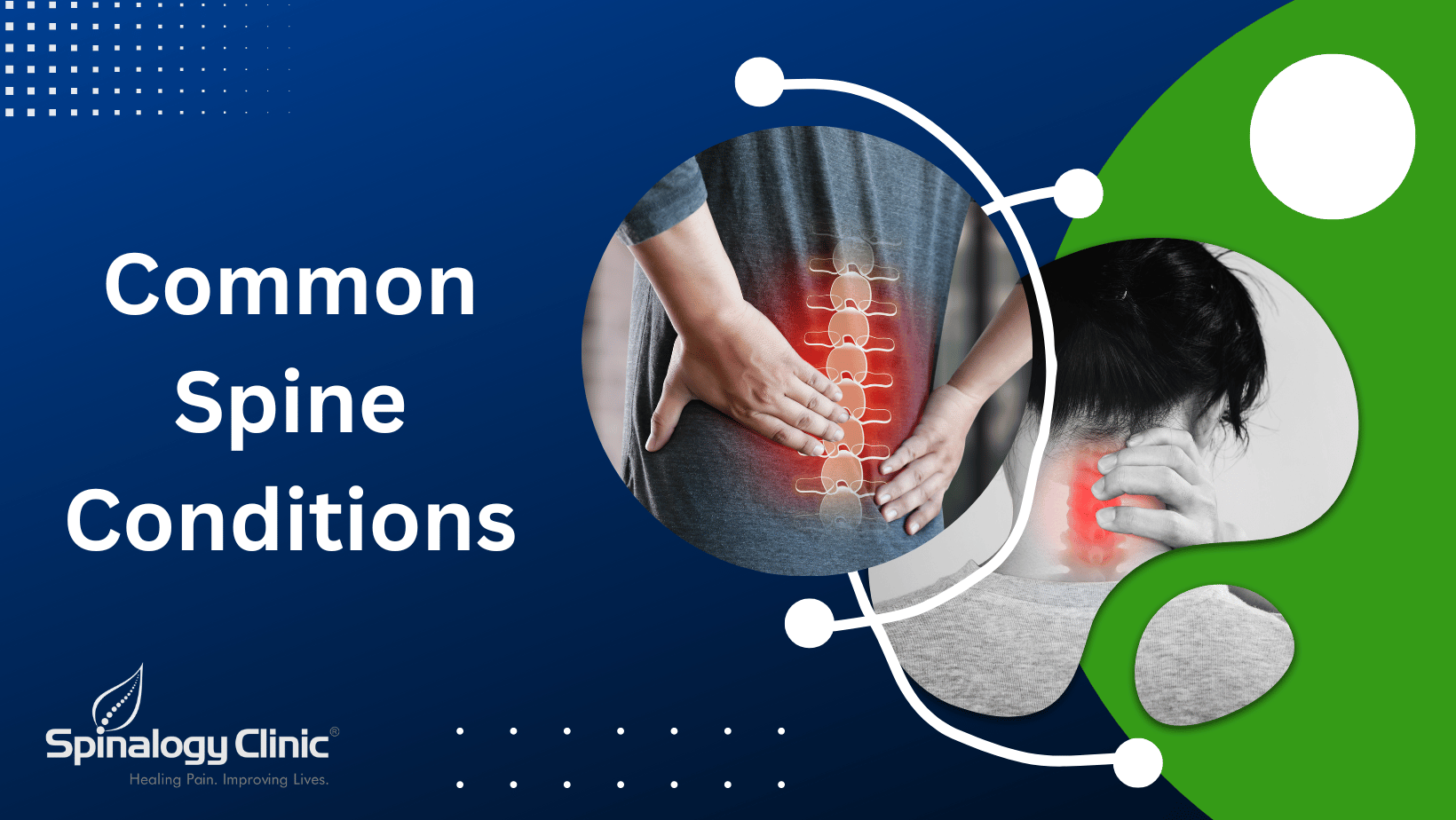 Understanding Common Spine Conditions | Spinalogy Blog | Best Back Pain ...