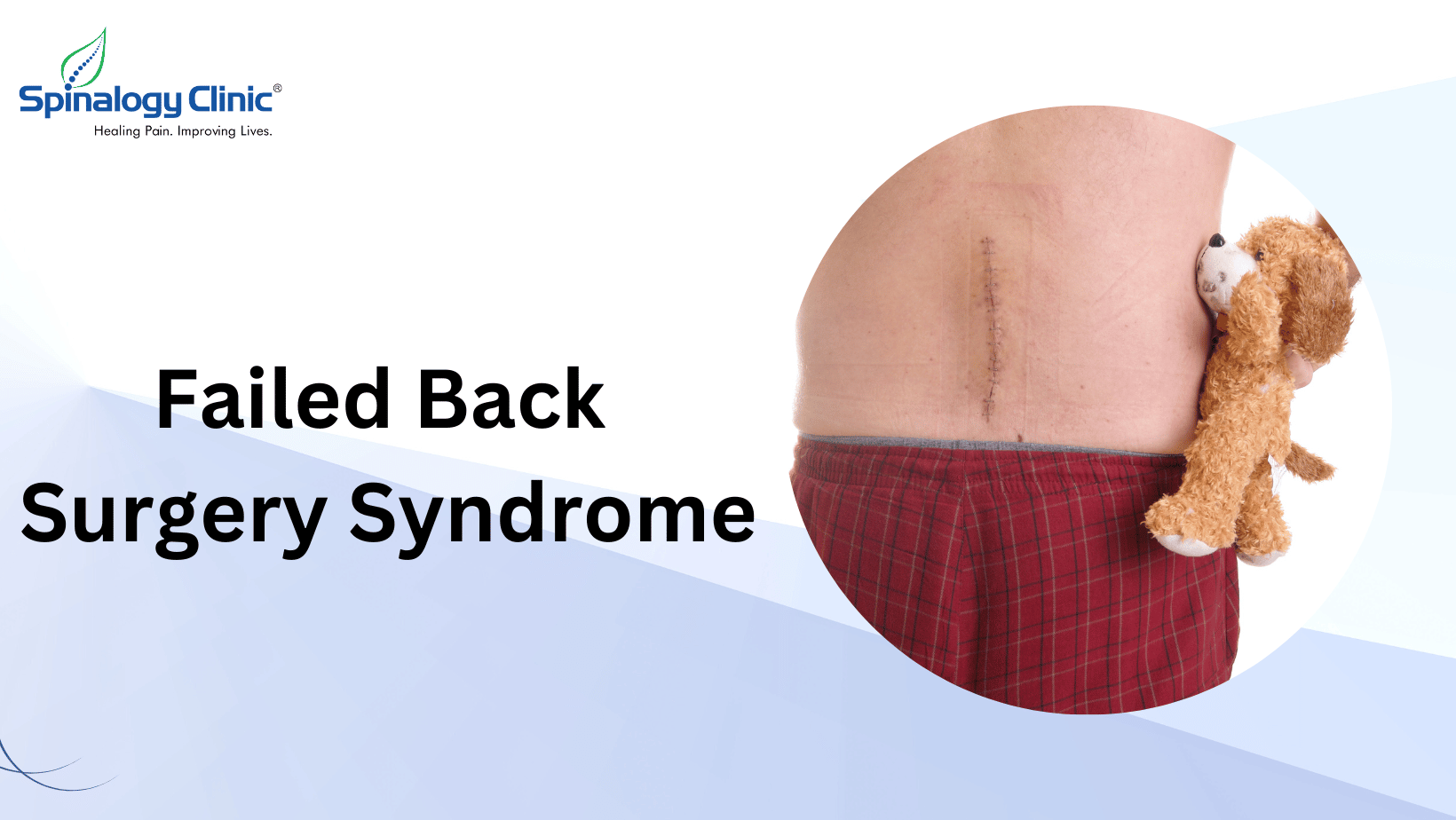 Understanding Failed Back Surgery Syndrome | Spinalogy | Best Back Pain ...