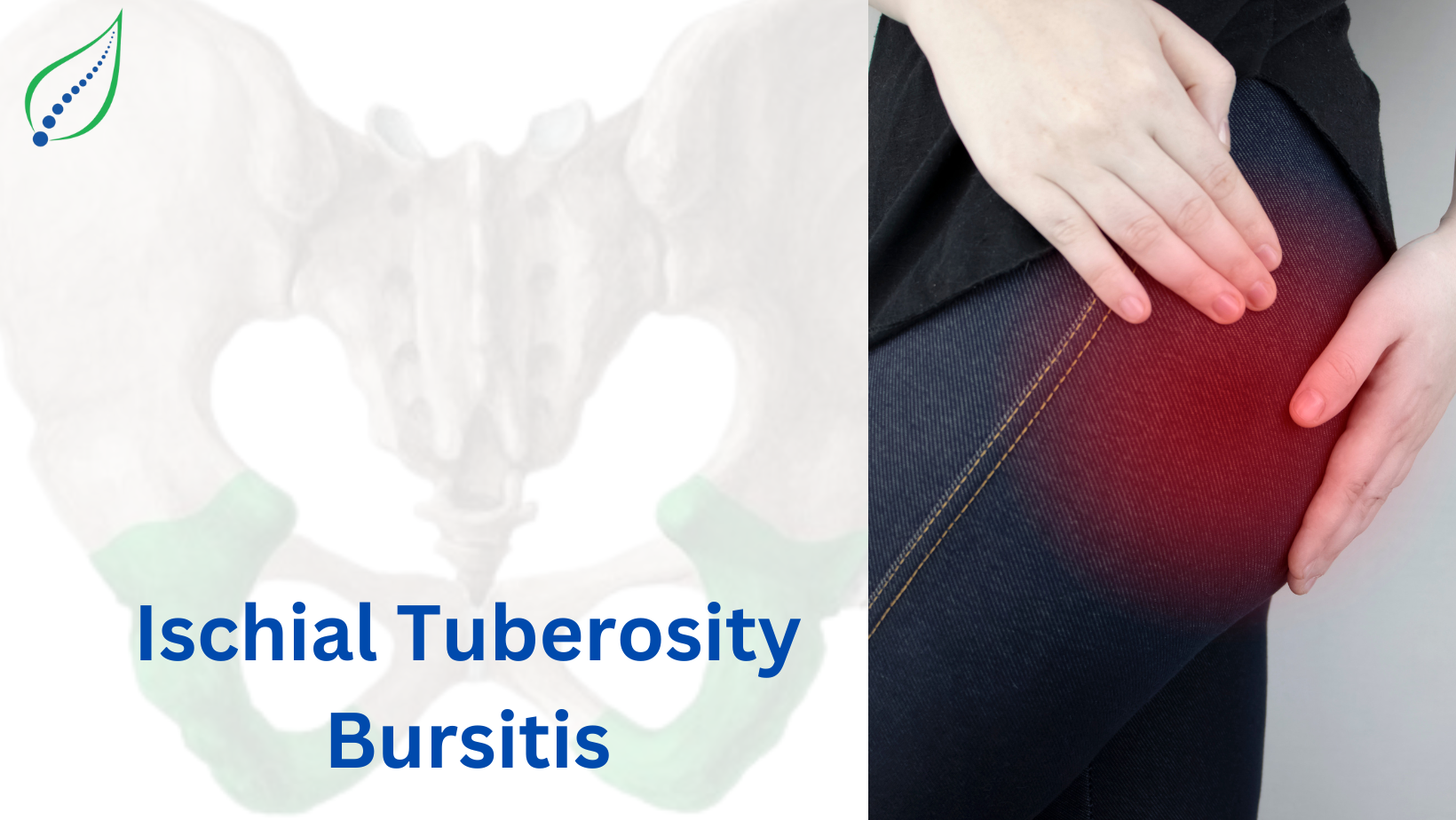 Ischial Tuberosity Bursitis: Causes, Symptoms & Treatment Options ...