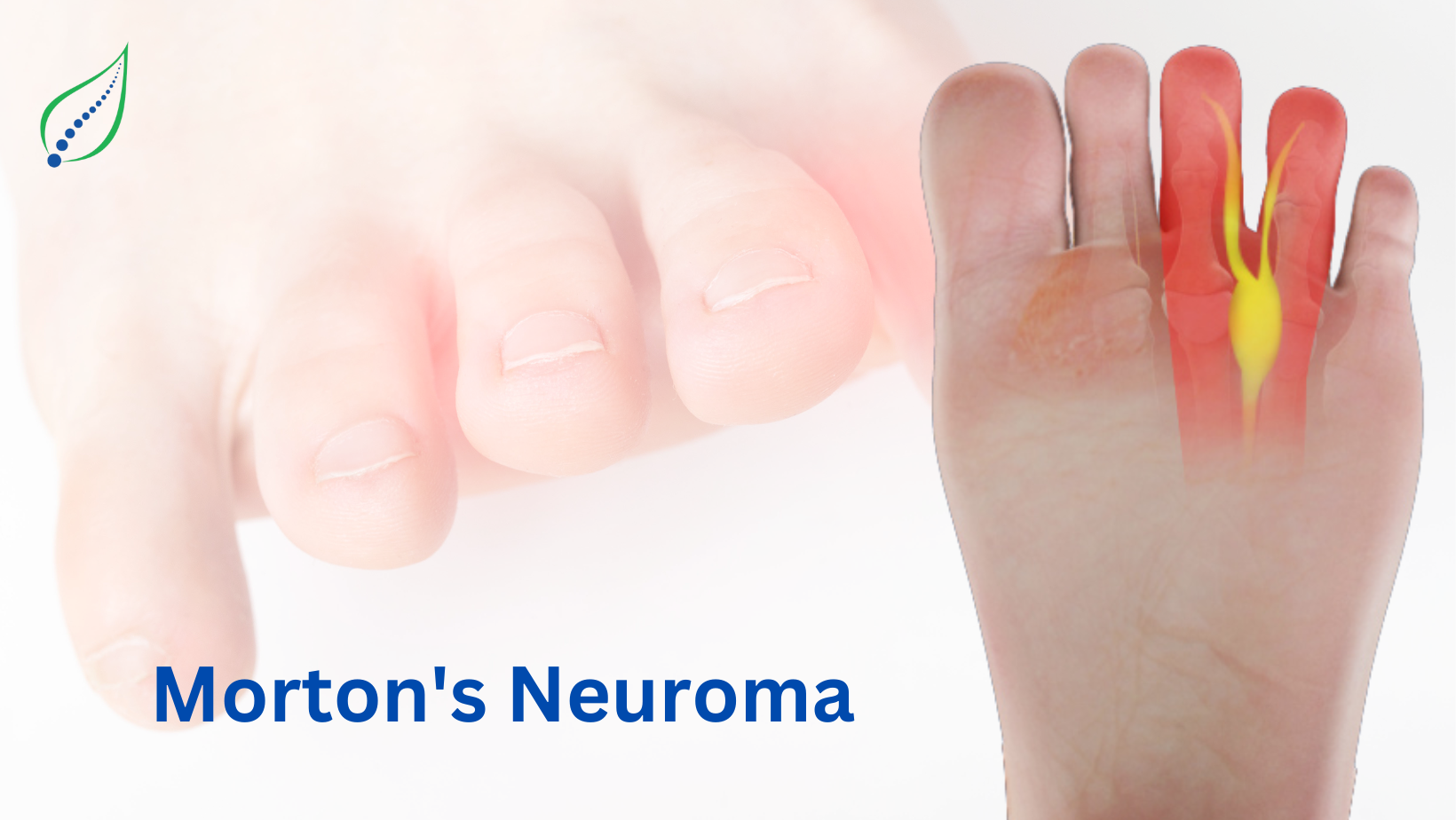 Morton's Neuroma: Causes, Symptoms, and Treatment | Best Back Pain ...