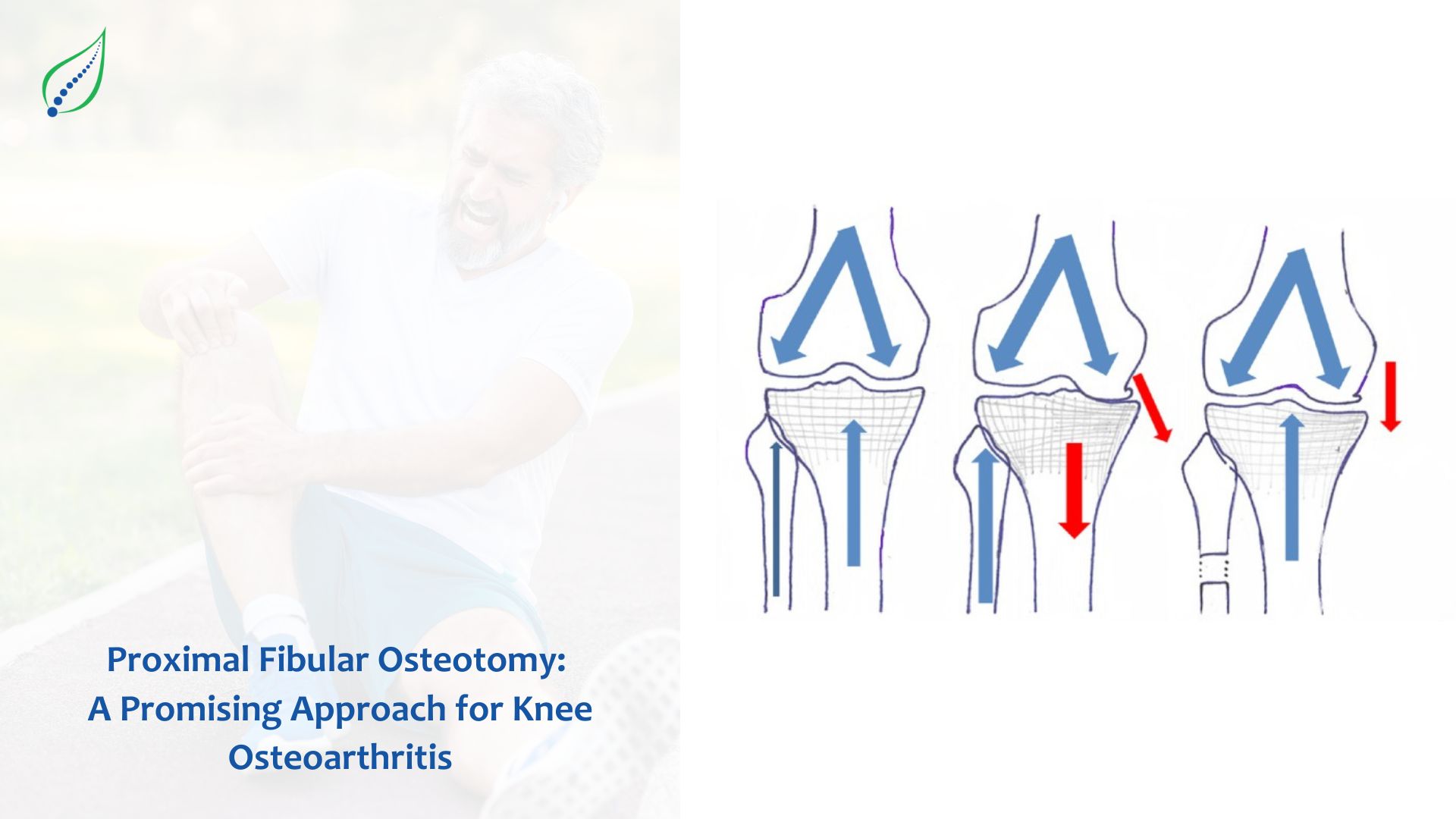 Proximal Fibular Osteotomy: Relief for Knee Osteoarthritis | Best Back ...