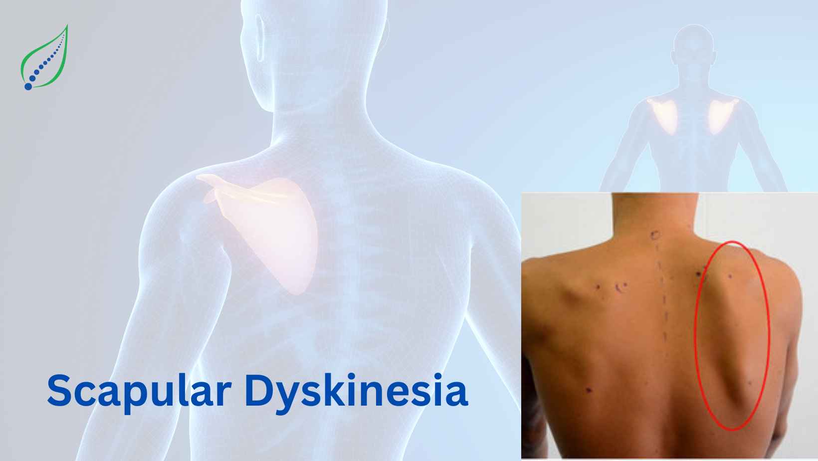 Best Scapular Dyskinesis Treatment | Spinalogy Clinic | Best Back Pain ...