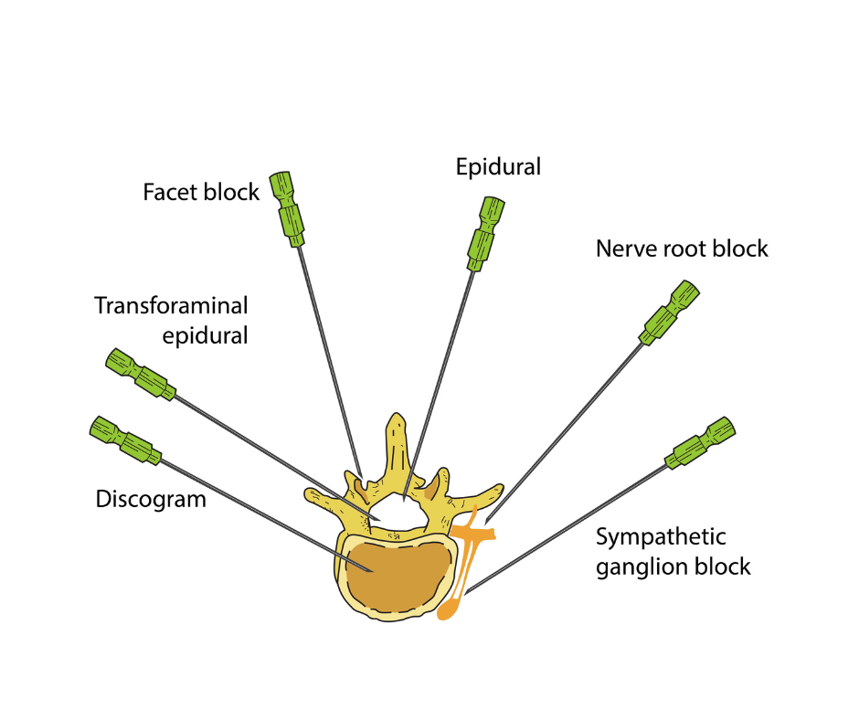 Slip Disc Injection at Jerome Cairns blog