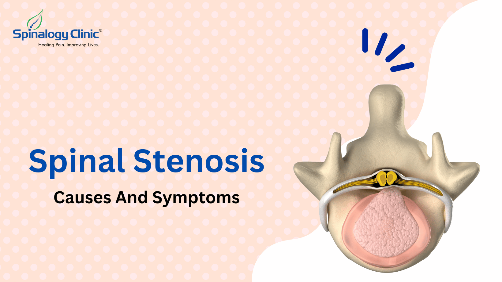 Understanding Spinal Stenosis: Causes, Symptoms & Treatment Options ...