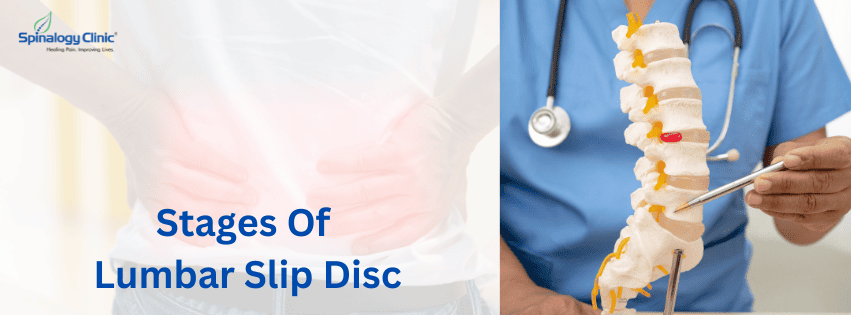 Slip disc | Best Back Pain, Slip Disc, Knee Arthritis, Sciatica ...