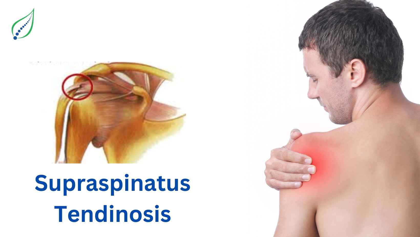 Best Treatment in Pune for Supraspinatus Tendinosis | Spinalogy | Best ...