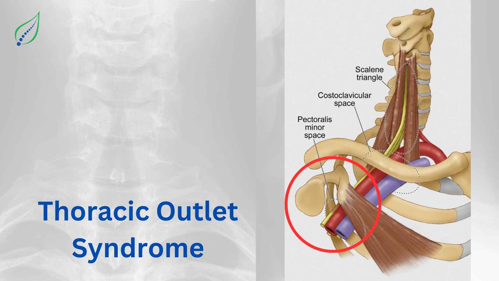 Best Thoracic Outlet Syndrome Care | Spinalogy Pune | Best Back Pain ...