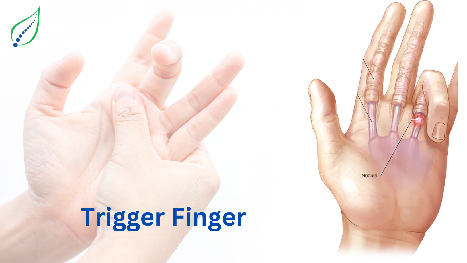 Trigger Finger: Causes, Symptoms, and Treatment Options | Best Back ...