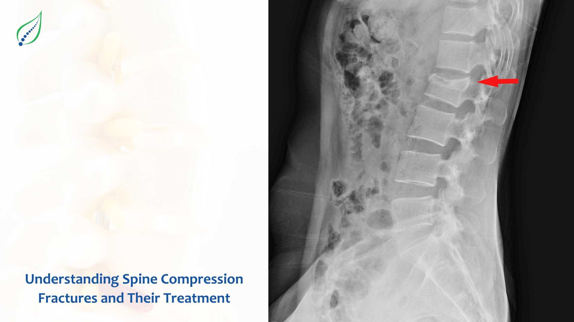Understanding Spine Compression Fractures & Treatments | Best Back Pain ...