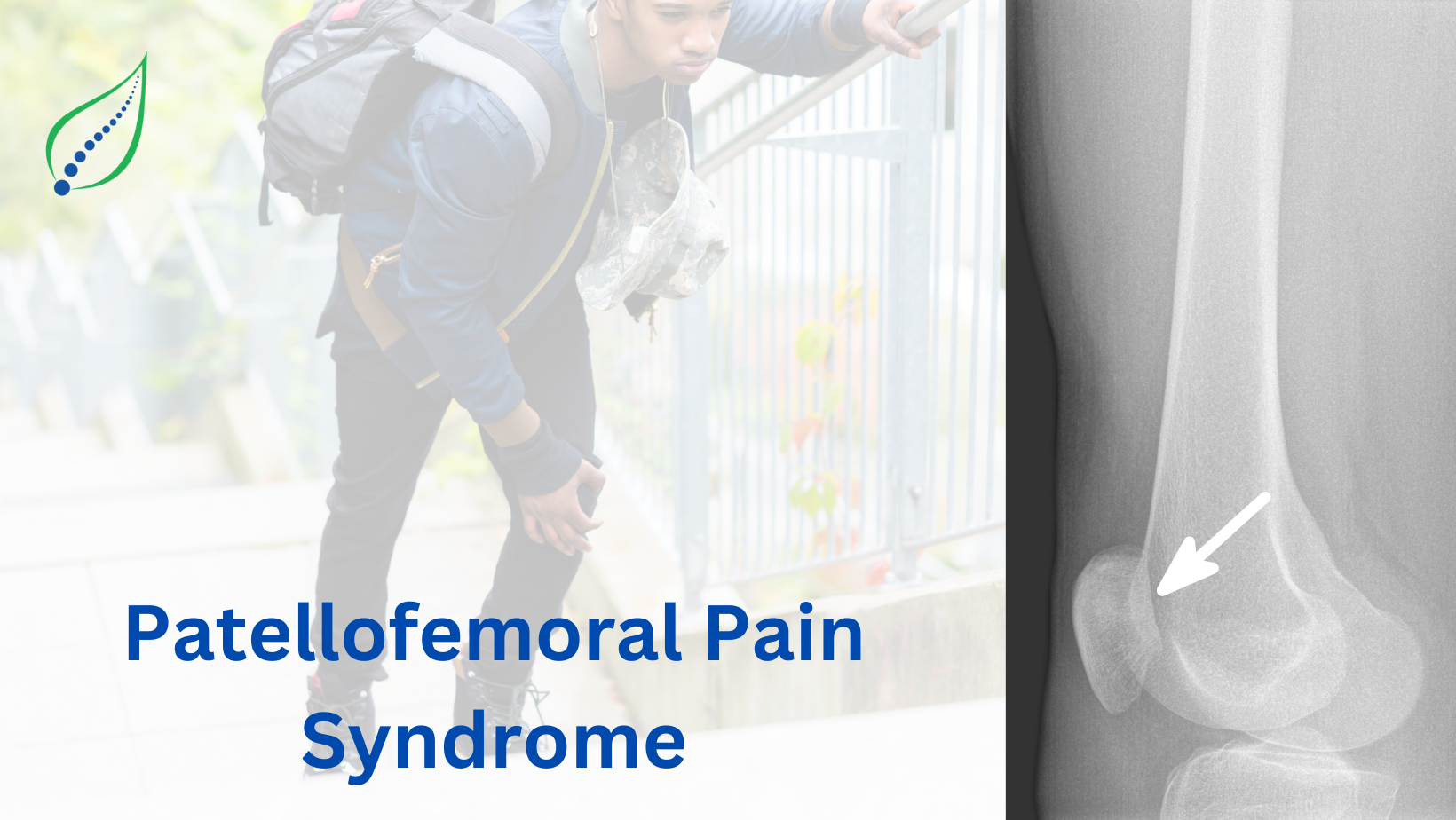 Non-Surgical Solutions for Patellofemoral Pain Syndrome | Best Back ...