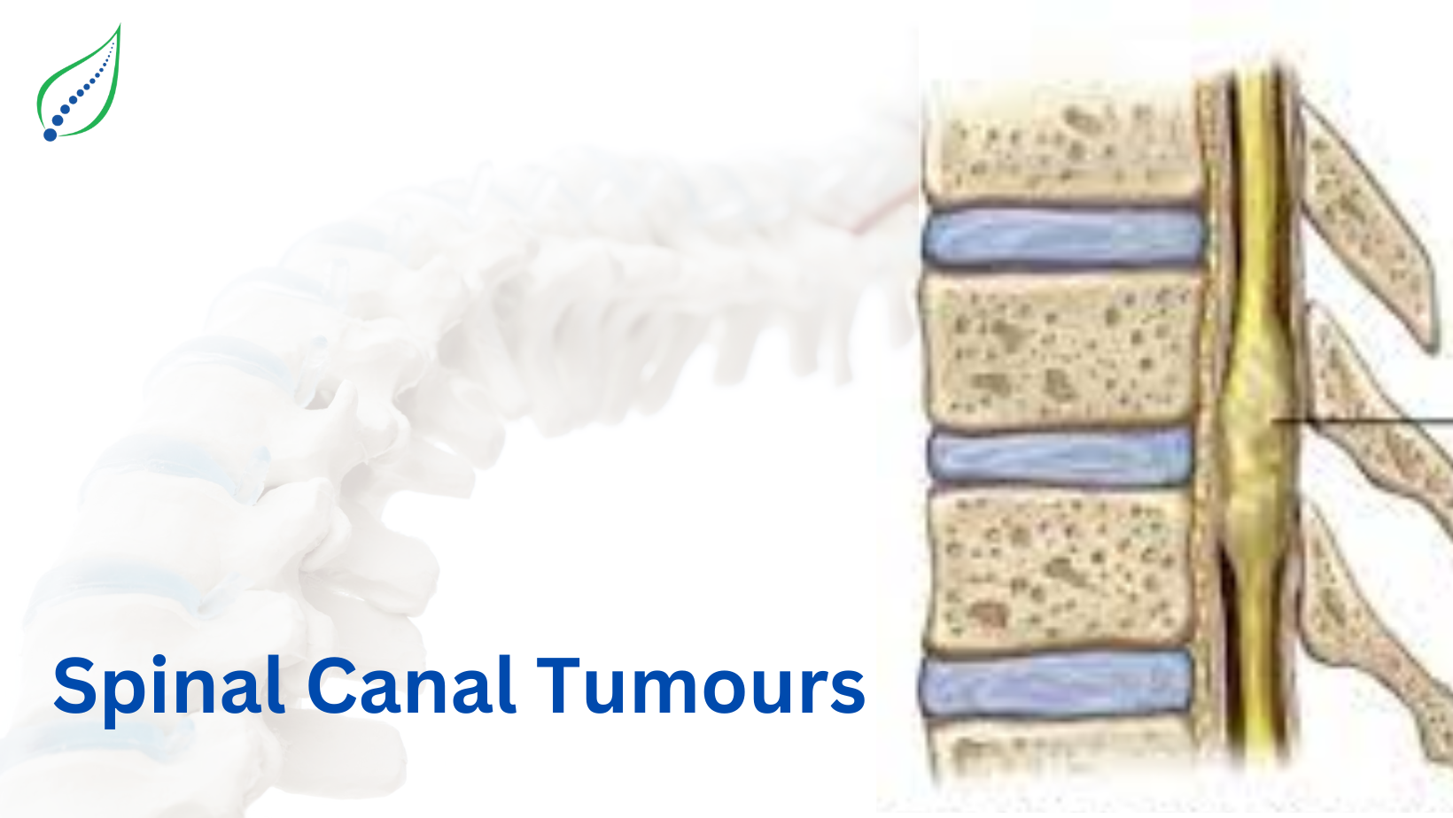 Spinal Canal Tumors: Symptoms, Diagnosis, and Treatment | Best Back ...